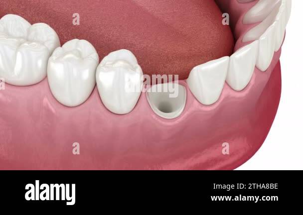 Dental stump pin tab on canaine tooth. Medically accurate dental 3D ...