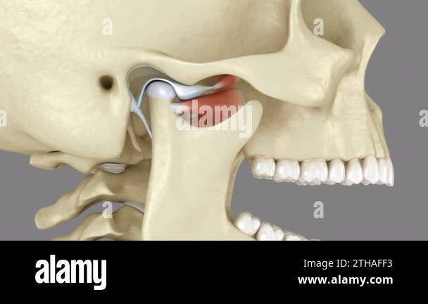 Temporomandibular joints and dislocated articular disc. Medically ...
