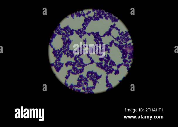 Researching of human biological sample using microscope. Biochemical ...