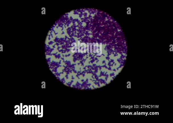 Smear of human biological sample culture Gram's stained with gram ...