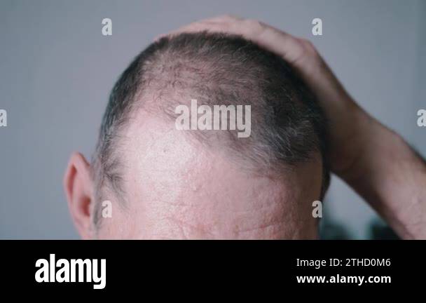 Balding baldness Stock Videos & Footage - HD and 4K Video Clips - Alamy
