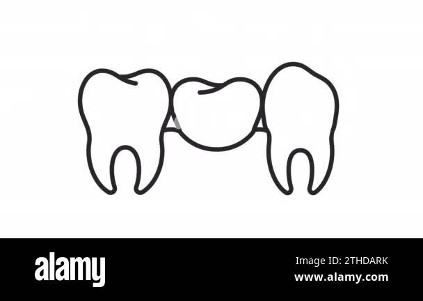 Animated bridge linear icon. Artificial teeth. Missing tooth ...