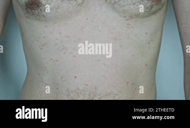 Pityriasis versicolor on the male body. The hand scratches the chest ...
