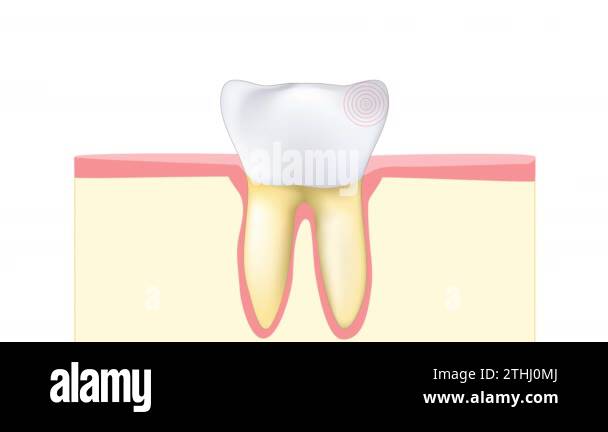 toothache. pain of the Molar or premolar tooth. 2D animation of ...