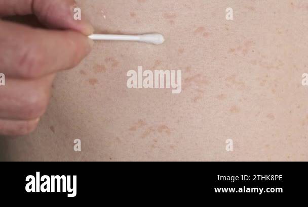Caucasian man smears red spots on his skin with a cotton swab ...