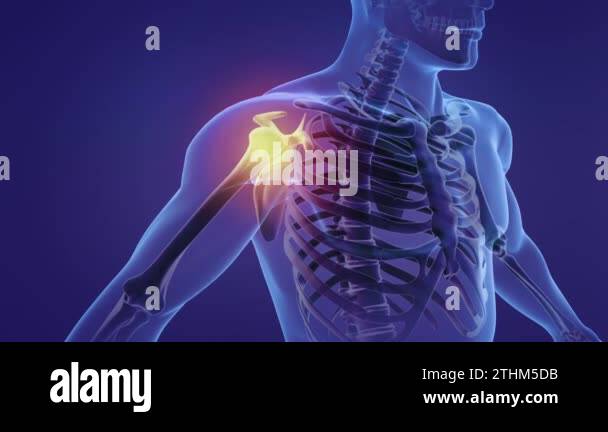Shoulder surgery illustration Stock Videos & Footage - HD and 4K Video ...