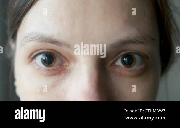 Close-up of a womans brown eyes with dilated big pupils. Eye drops ...