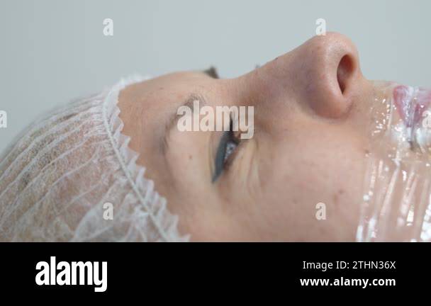 Lip injection procedure. Plastic surgery. Lip contouring procedure ...