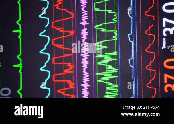Modern patient monitor. Electronic Health Monitor displaying medical ...