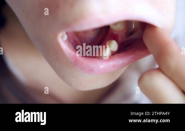 Orthodontic gum Stock Videos & Footage - HD and 4K Video Clips - Alamy