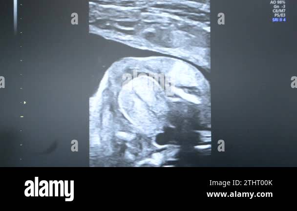 Ultrasound on monitor. Ultrasound image on computer monitor screen ...
