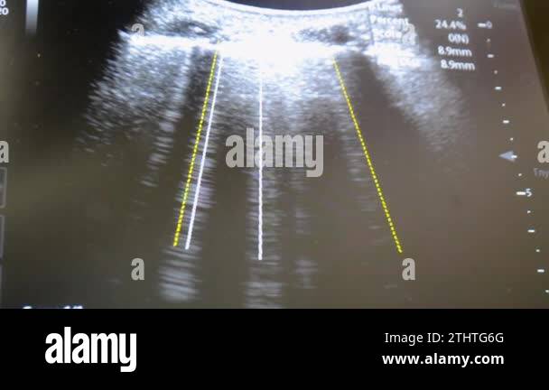 Ultrasound on monitor. Ultrasound image on computer monitor screen ...