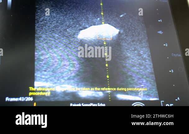 Ultrasound on monitor. Ultrasound image on computer monitor screen ...