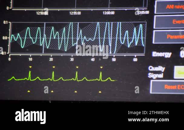 Modern patient monitor. Electronic Health Monitor displaying medical ...