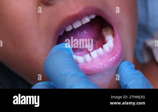 Close-up inside the oral cavity of a healthy child with beautiful rows ...
