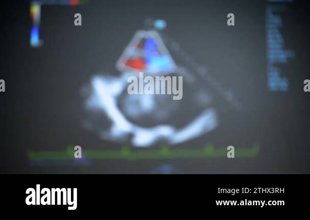 Blurred background. Utrasound image on monitor. Ultrasound Scan display ...