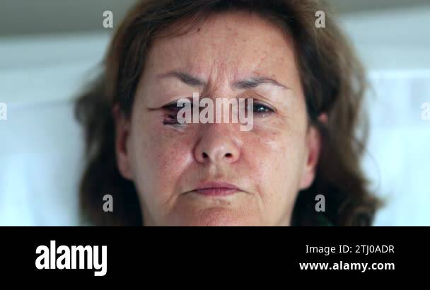Basal cell carcinoma eye Stock Videos & Footage - HD and 4K Video Clips ...
