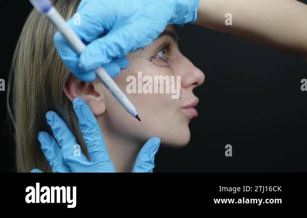 Process of surgical marking of cheekbones and area around eyes of ...