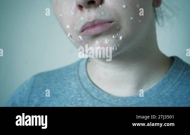 Close up of skin problems, unhealthy skin with acne and pimples. Porous ...