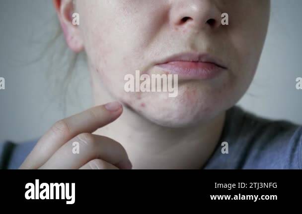 Close up of skin problems, unhealthy skin with acne and pimples. Porous ...