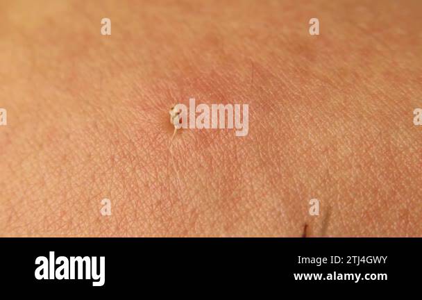 Bee's venom sac. Honey bee stings a man's arm. When the sting is over ...