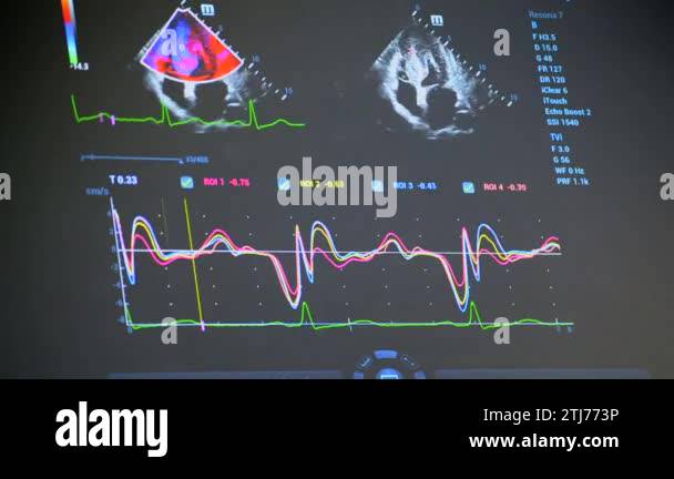 Modern patient monitor. Electronic Health Monitor displaying medical ...