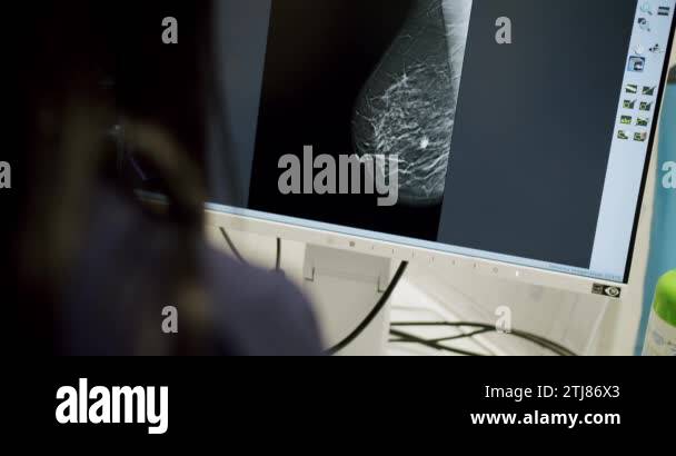 Breast scan on computer monitor. Mammography device in a modern ...