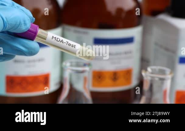 Urine samples for testing MDA in the laboratory, urine sample in test ...