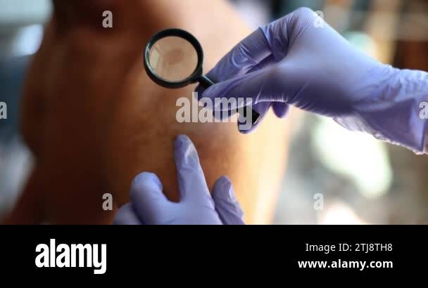 A doctor with a magnifying glass examines the skin of a man, close-up ...