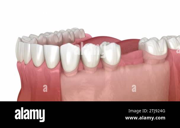 Dental implant instalation, custom abutment and ceramic crown ...
