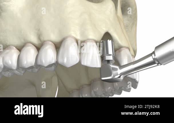 Bone grafting- augmentation using ring method, tooth implantation ...