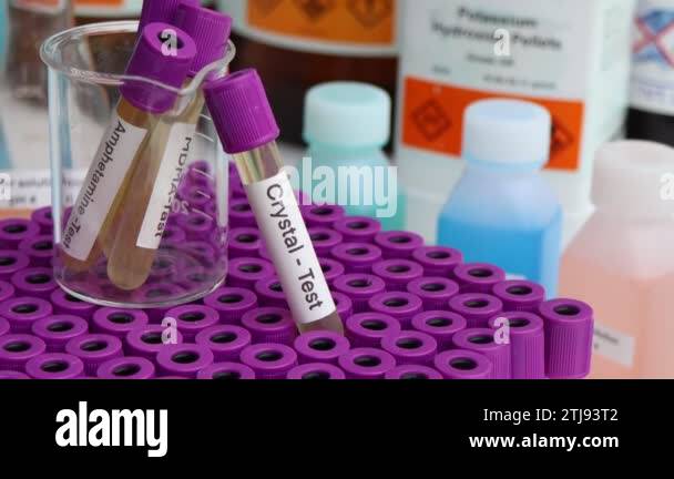 Urine samples for testing Crystal in the laboratory, urine sample in ...