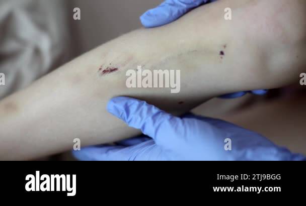 Leg case Stock Videos & Footage - HD and 4K Video Clips - Alamy