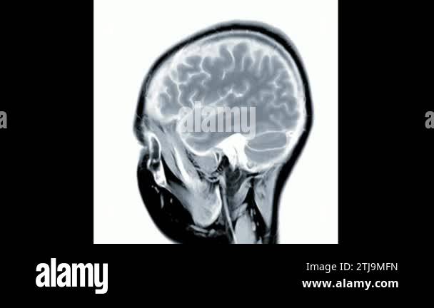 Healthy brain ct scan Stock Videos & Footage - HD and 4K Video Clips ...