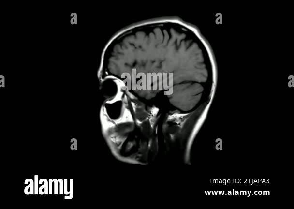 MRI brain scan magnetic resonance imaging top Neurology data analysis ...