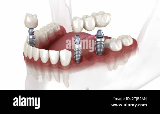 Dental bridge and crown placement over implants. Dental 3D animation ...