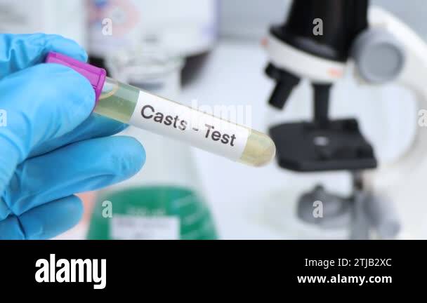 Urine samples for testing Casts in the laboratory, urine sample in test ...