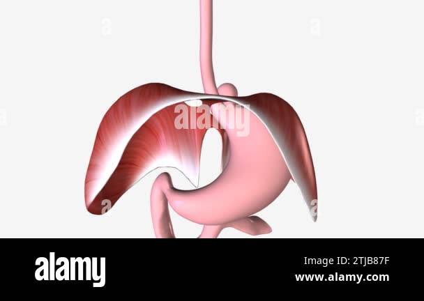 Paraesophageal hernia or hiatal hernia occurs when a portion of the ...