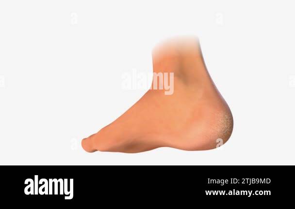 Hardened skin Stock Videos & Footage - HD and 4K Video Clips - Alamy