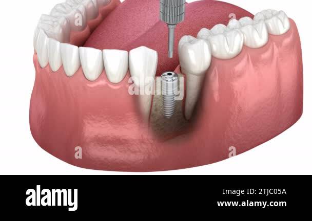 Cover screw and healing cap over implant. Medically accurate dental 3D ...