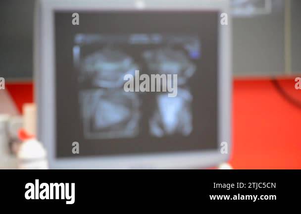Blurred background. Utrasound image on monitor. Ultrasound Scan display ...