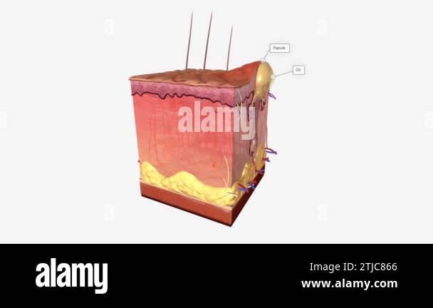 Acne Papule Papule is a type of acne characterized by a large, inflamed ...