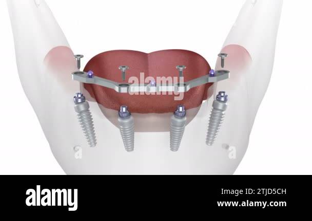 Mandibular prosthesis with gum All on 4 system supported by implants ...