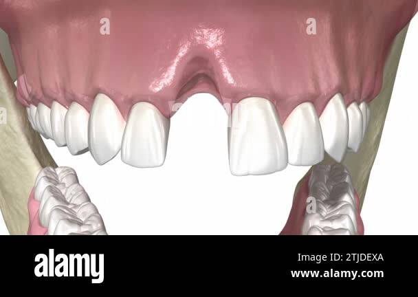 Bone grafting- augmentation using artificial bone and membrane, tooth ...