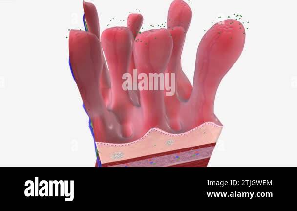 Gastroenteritis is a short-term illness triggered by the infection and ...