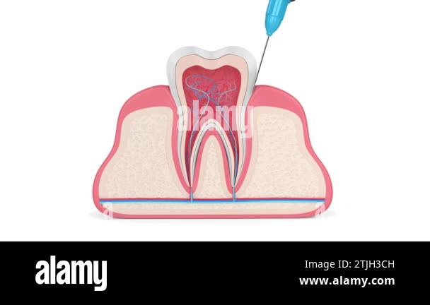 Tooth in gums with intraligamentary anesthesia procedure Stock Video ...