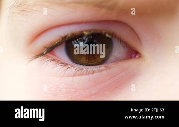 Eye of a 5-year-old child with conjunctivitis, inflammation of the ...