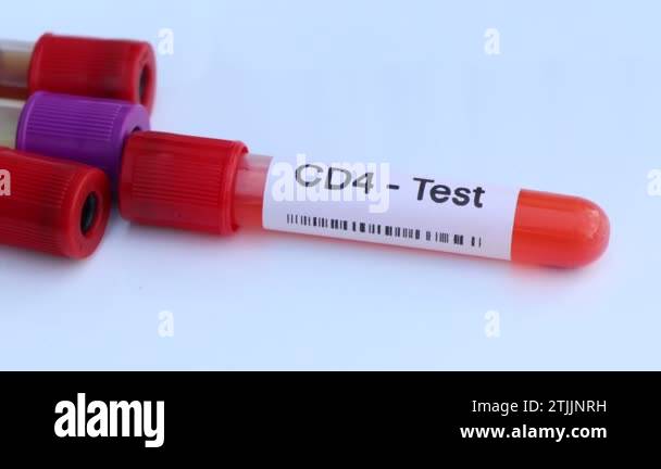 CD4 test to look for abnormalities from blood, blood sample to analyze ...