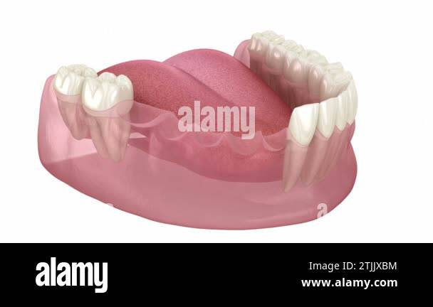 Dental bridge based on 3 implants. Medically accurate 3D animation of ...