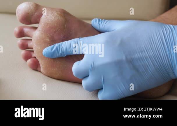 Dry skin, Foot psoriasis The skin is damaged. Dermatitis, eczema ...